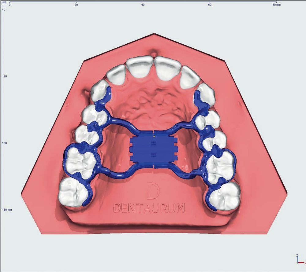 hyrax® Mini – 7, angulated - DENTAURUM Canada Online Shop
